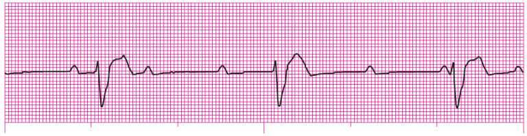 ACLS Precourse Self Assessment Answers (Pharmacology, Rhythm)