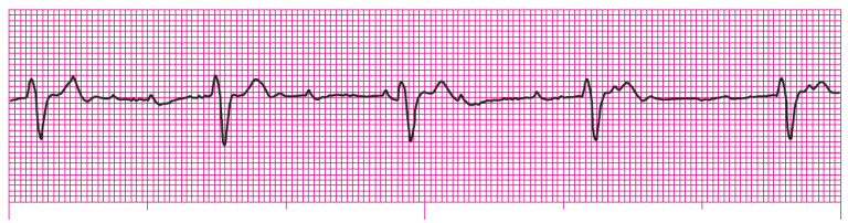 ACLS Precourse Self Assessment Answers (Pharmacology, Rhythm)