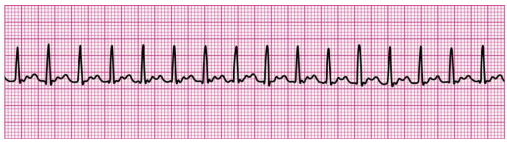 ACLS Exam Version A 2023 [Questions Answers]