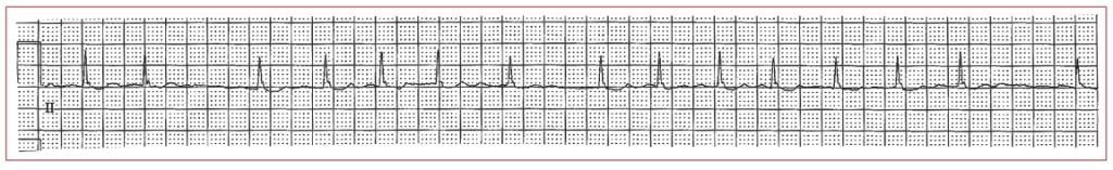 EKG Practice Test for the Nurse Practitioner and Physician Assistant