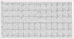 EKG Multiple Choice Practice Test Questions Answers 2025